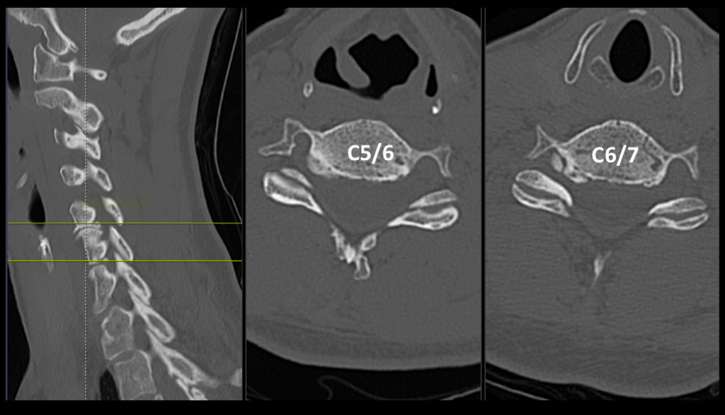 ACDF - Joshua Li, MD, PhD