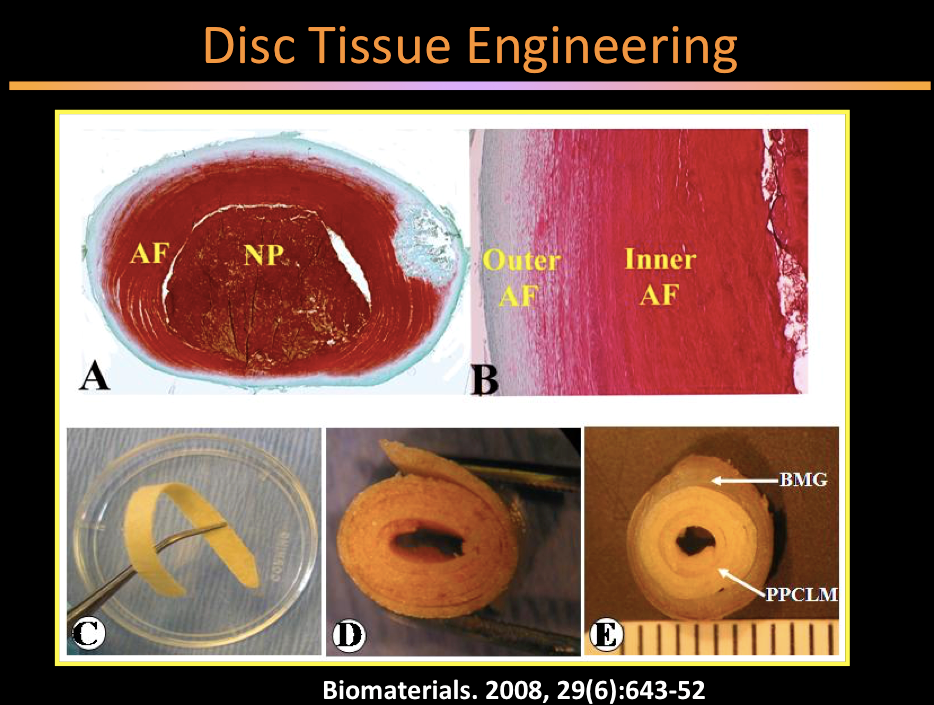 Disc Degeneration Therapy - Joshua Li, MD, PhD