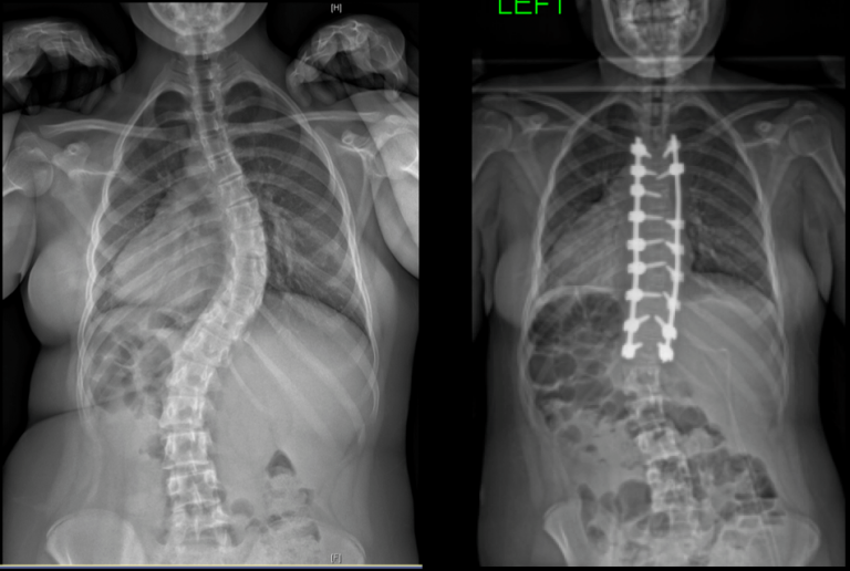 Scoloisis Reconstruction - Joshua Li, MD, PhD