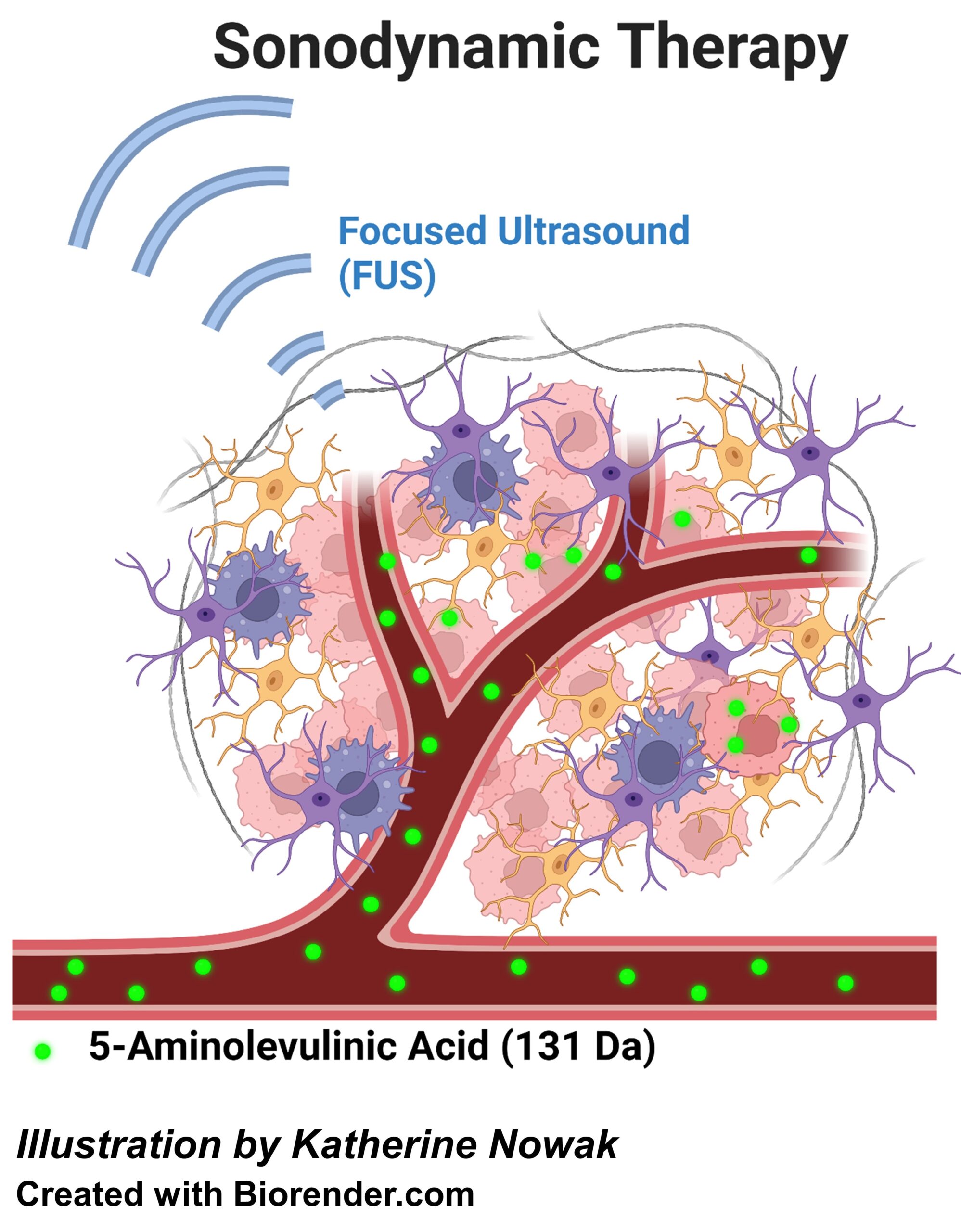 Sonodynamic Therapy - Focused Ultrasound Immuno-Oncology (FUSION) Center